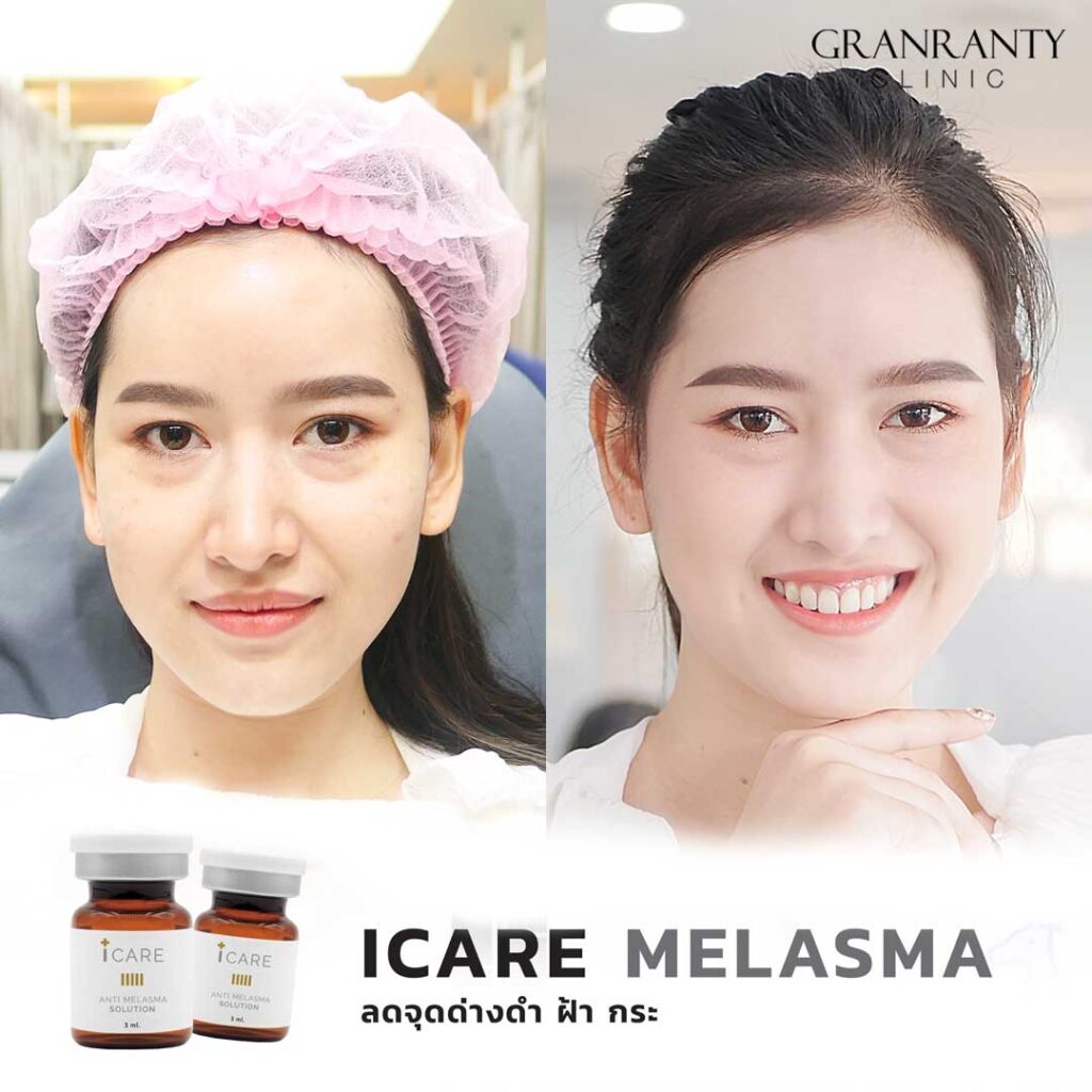 รีวิว ICARE MELASMA (ปรับหน้าใส ลดรอยดำจากสิว ลดฝ้า กระ) – G Clinic ...